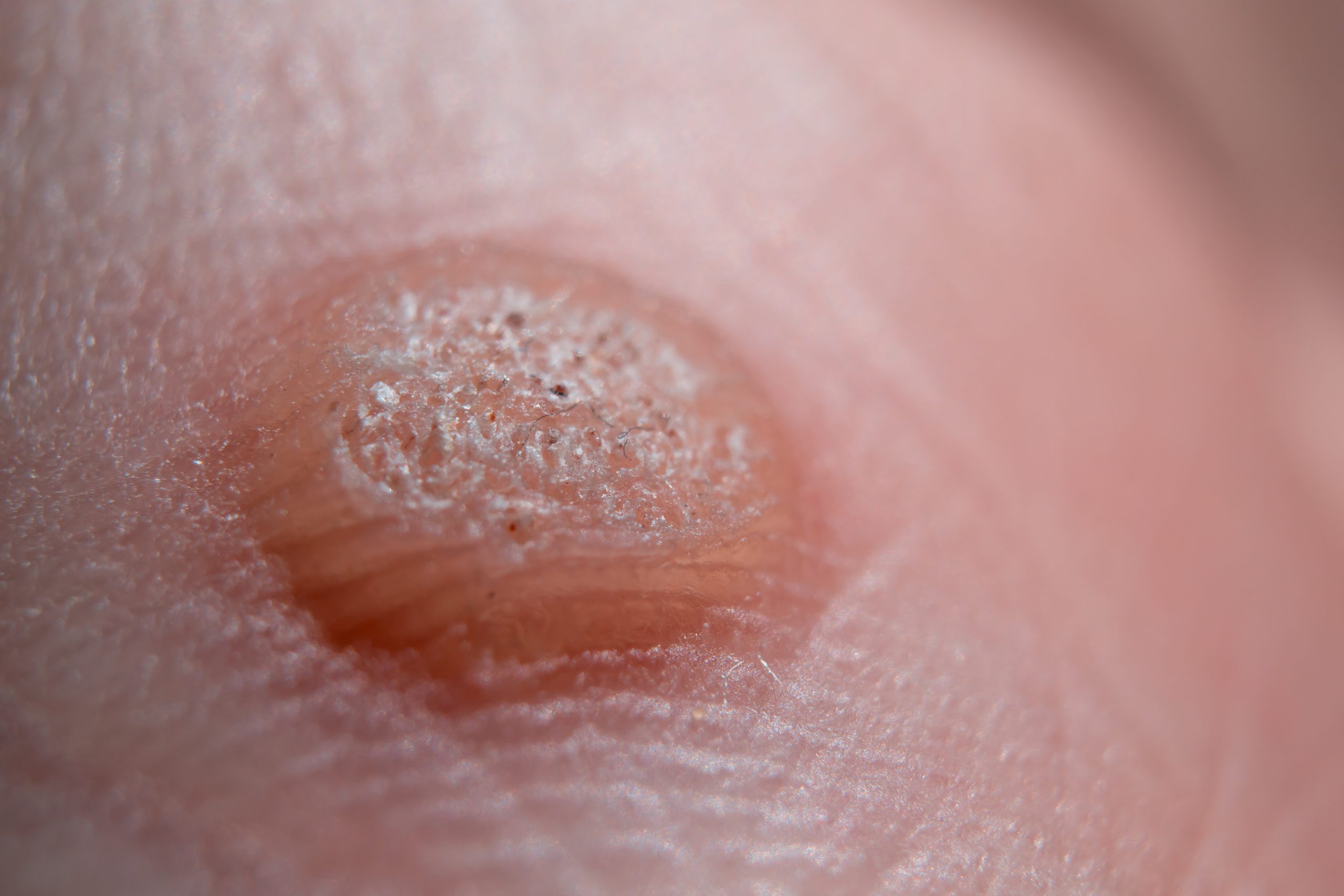 Wart Removal ProSkin Clinic Health UK Gloucester Wart Removal ProSkin Clinic Health UK Gloucester