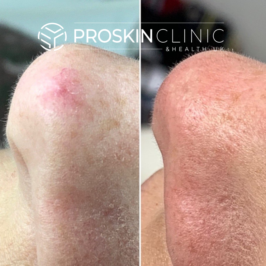 BLOOD SPOT Removal - ProSkin Clinic & Health UK - Skin Tag Removal ...