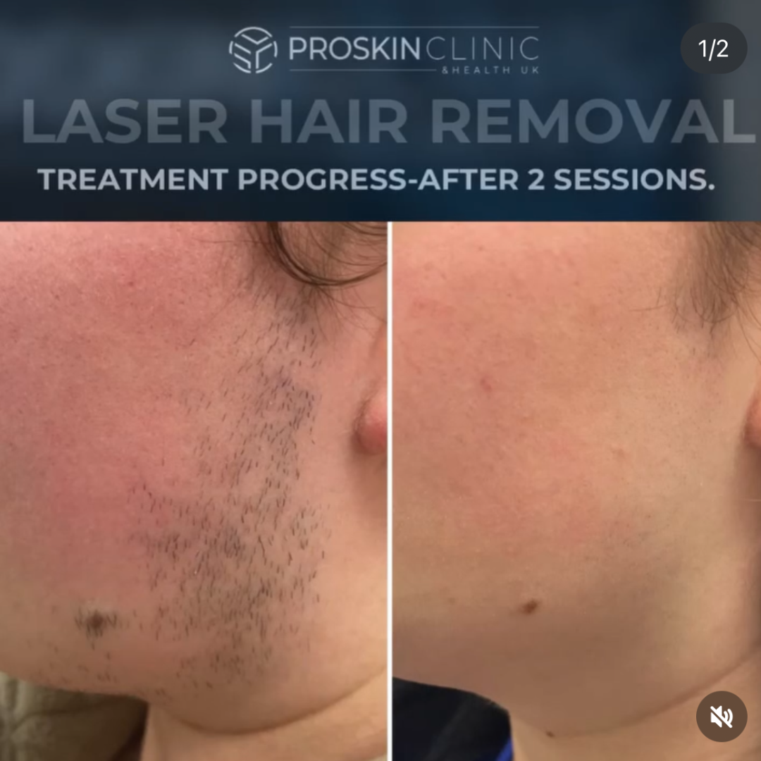 Laser Hair Removal ProSkin Clinic Health UK