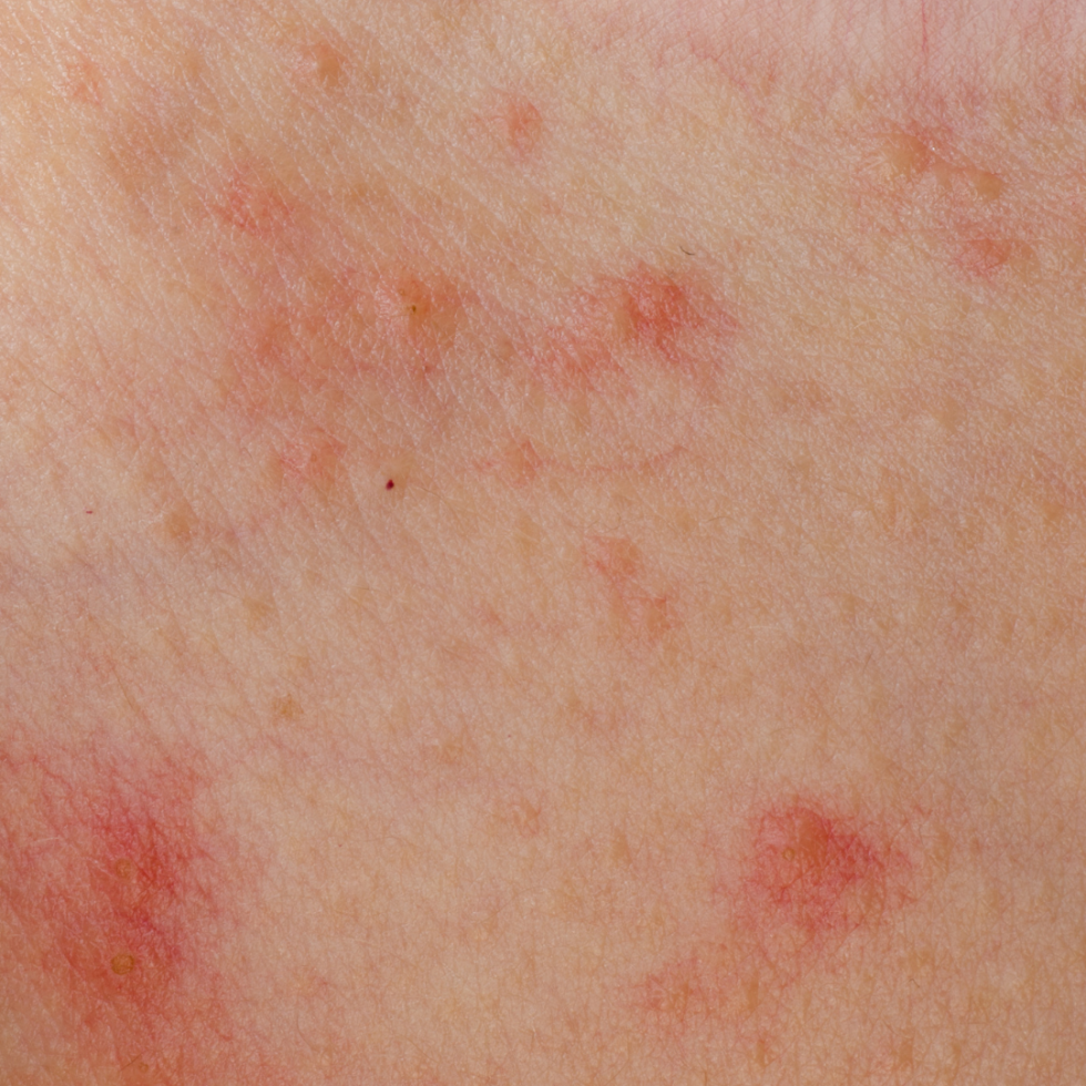 Beat the Burn: 10 top Tips to Get Rid of Shaving Rash - ProSkin Clinic ...