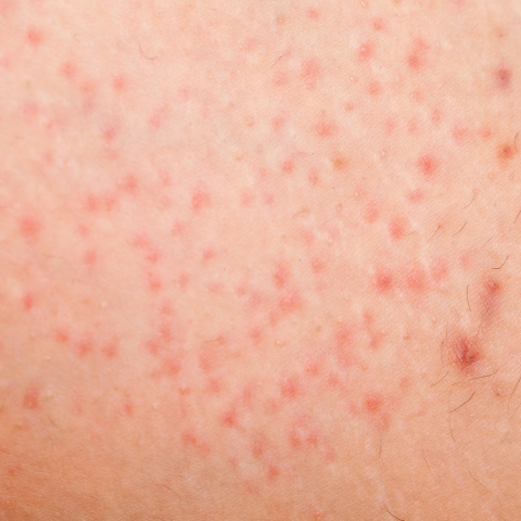 Beat the Burn: 10 top Tips to Get Rid of Shaving Rash - ProSkin Clinic ...