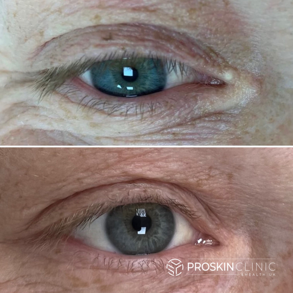 Milia Removal - ProSkin Clinic & Health UK - Skin Tag Removal, Gloucester